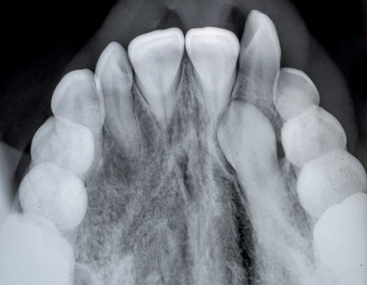 Impacted Canines | Alliance Oral & Maxillofacial Surgery
